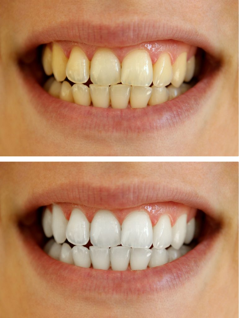 Teeth Whitening in Springfield for a Beautiful Smile